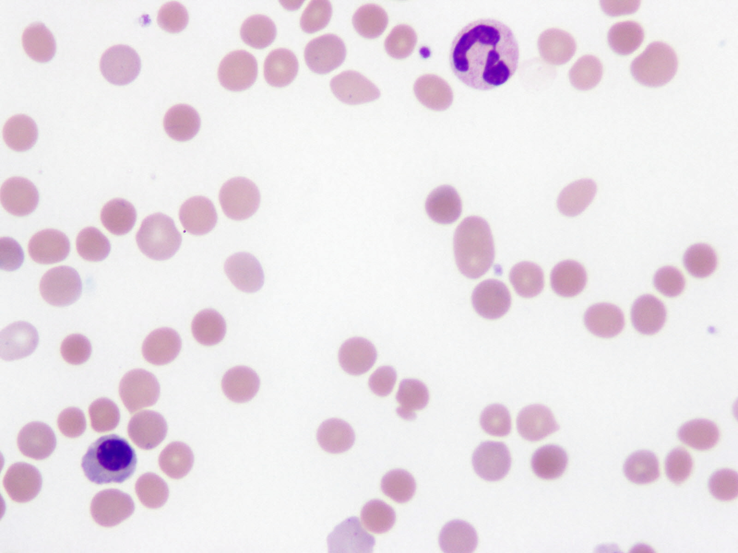 The Pathology Test - Direct antiglobulin test