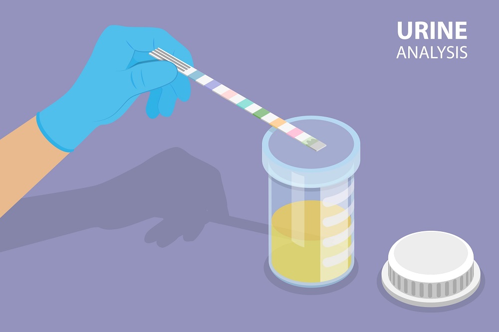 Urine dipstick and microscopy (Urinalysis) | Pathology Tests Explained