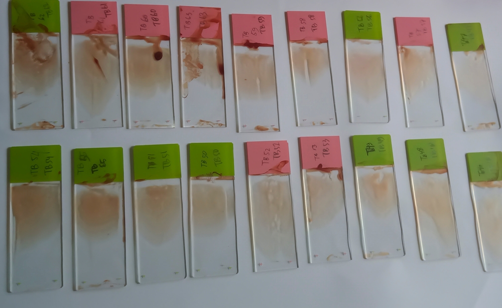 Immunophenotyping | Pathology Tests Explained